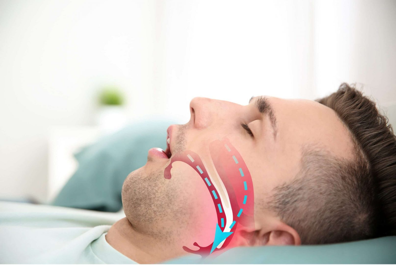 L’apnée du sommeil - Clinique dentaire Beaulieu, Lapointe et associés