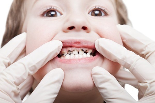 Early childhood caries: what is it and how can it be prevented ...