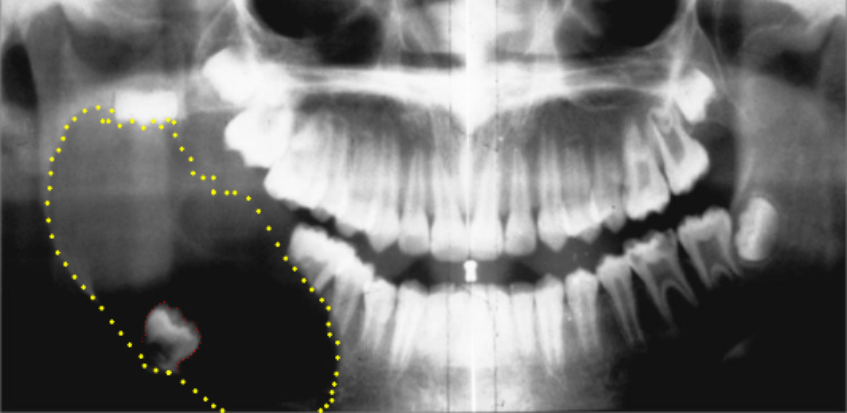 Cysts around impacted wisdom teeth - Clinique dentaire Beaulieu et associés