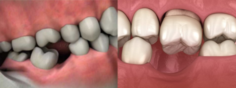 Missing teeth: why should they be replaced? - Clinique dentaire ...